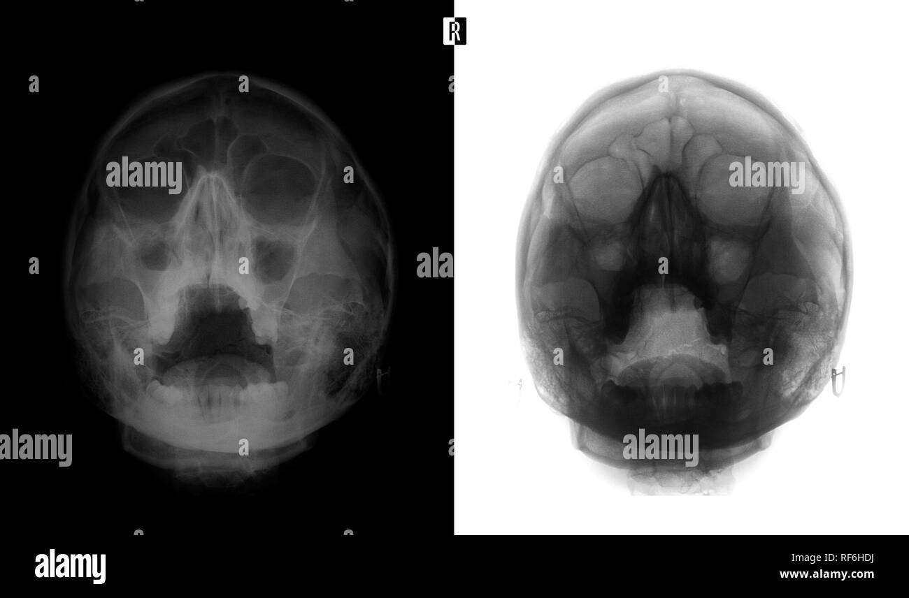 Paranasal sinuses immagini e fotografie stock ad alta risoluzione - Alamy