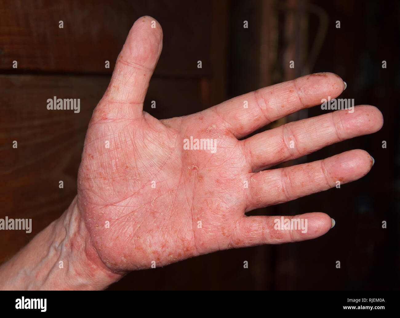 Eczema endogeno immagini e fotografie stock ad alta risoluzione - Alamy