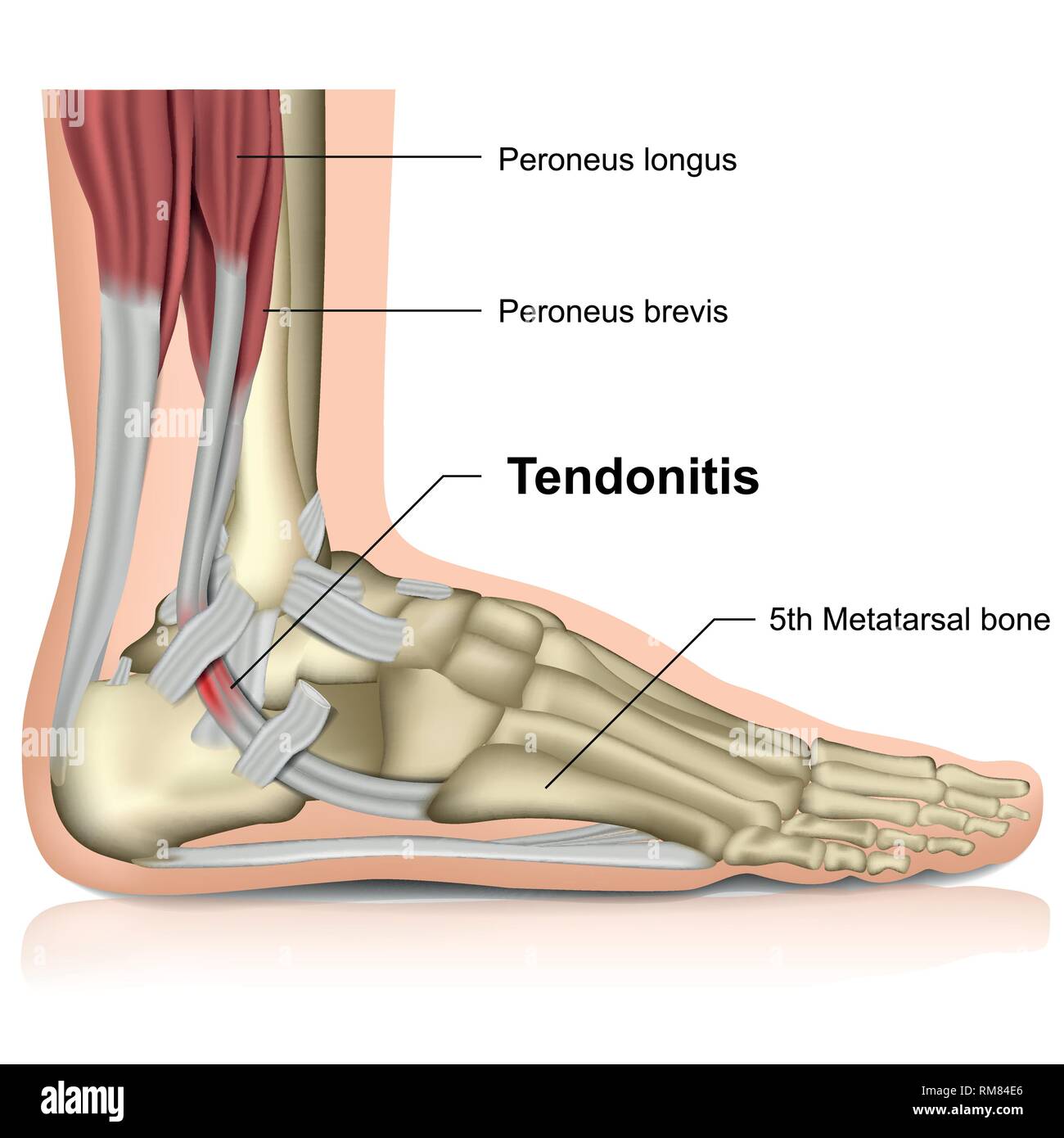 Peroneo tendinite ,della caviglia 3d medical illustrazione vettoriale ...
