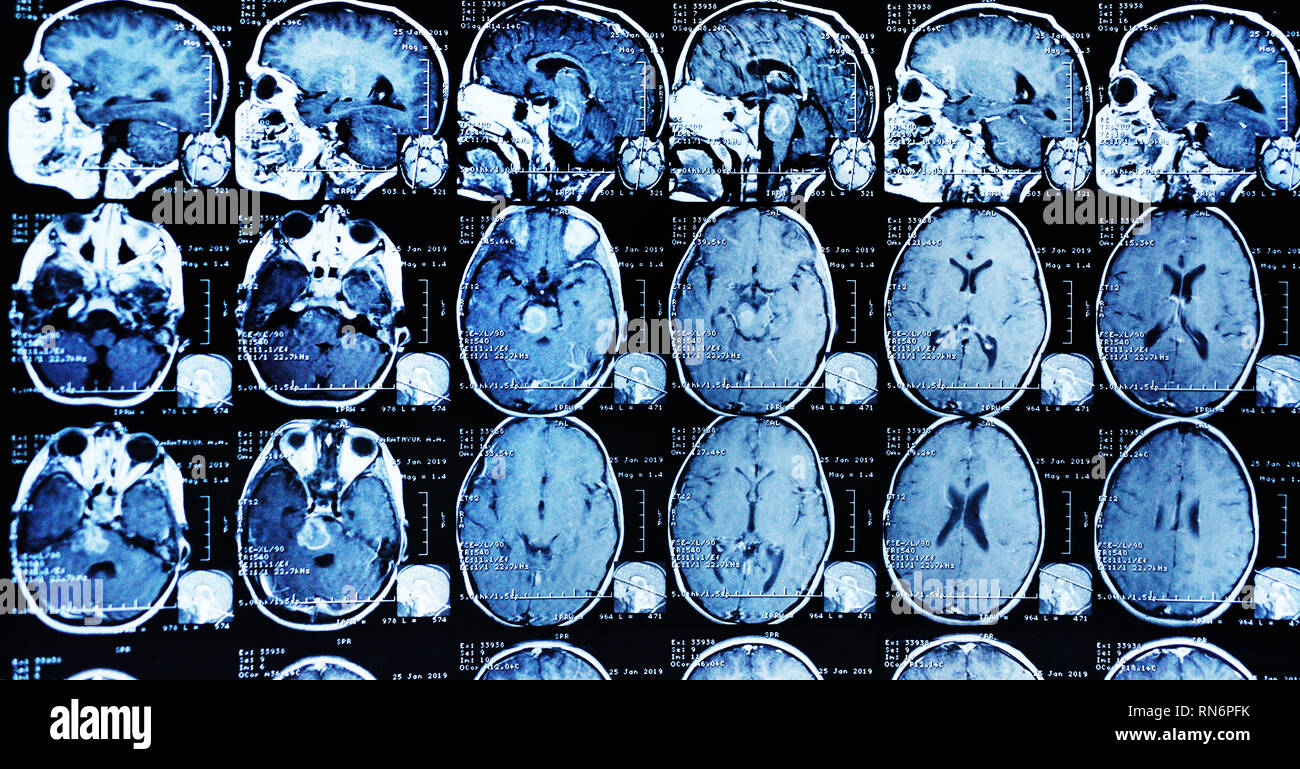 Primo piano della scansione mri del cervello umano immagini e ...