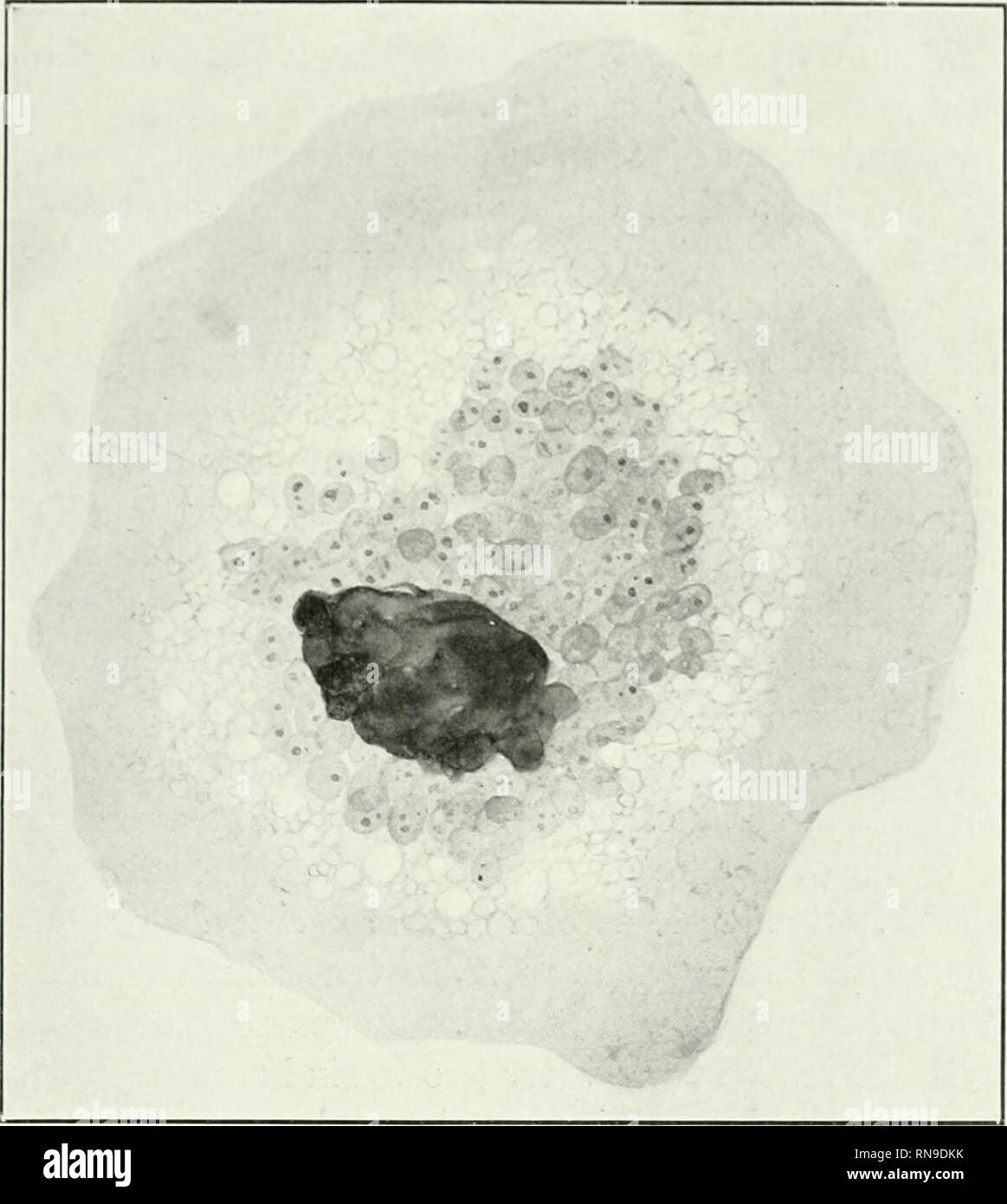 Cellule giganti multinucleate immagini e fotografie stock ad alta ...