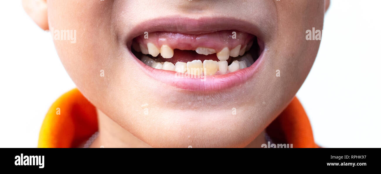 Denti marci immagini e fotografie stock ad alta risoluzione - Alamy