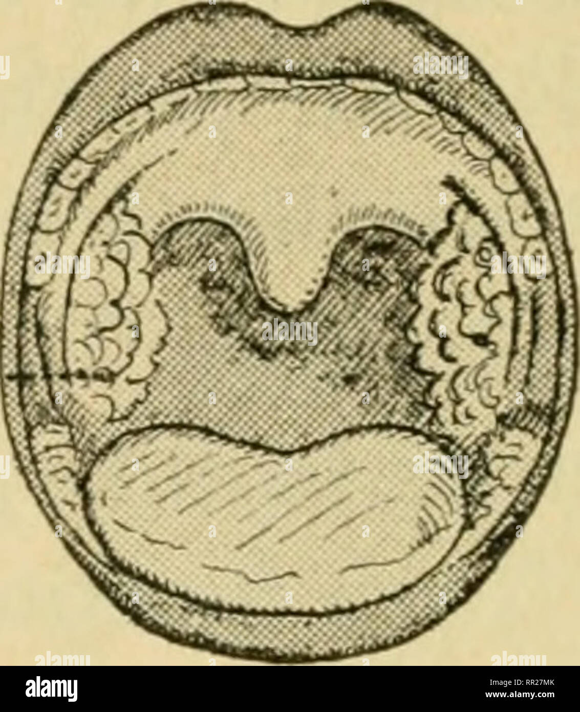 Tonsille normali immagini e fotografie stock ad alta risoluzione - Alamy