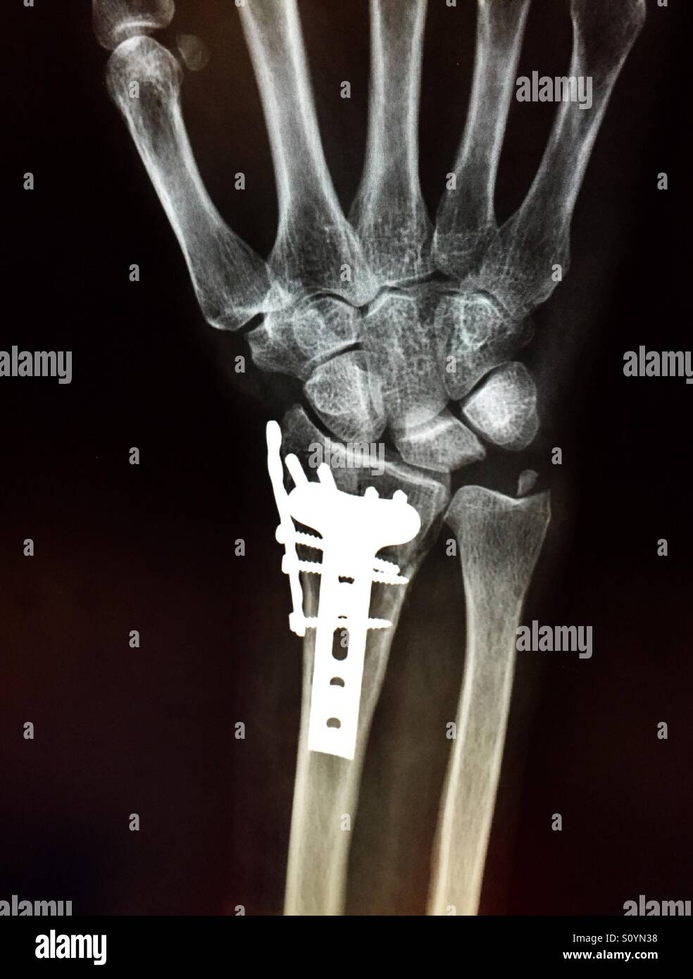 Chirurgia delle ossa rotte immagini e fotografie stock ad alta ...