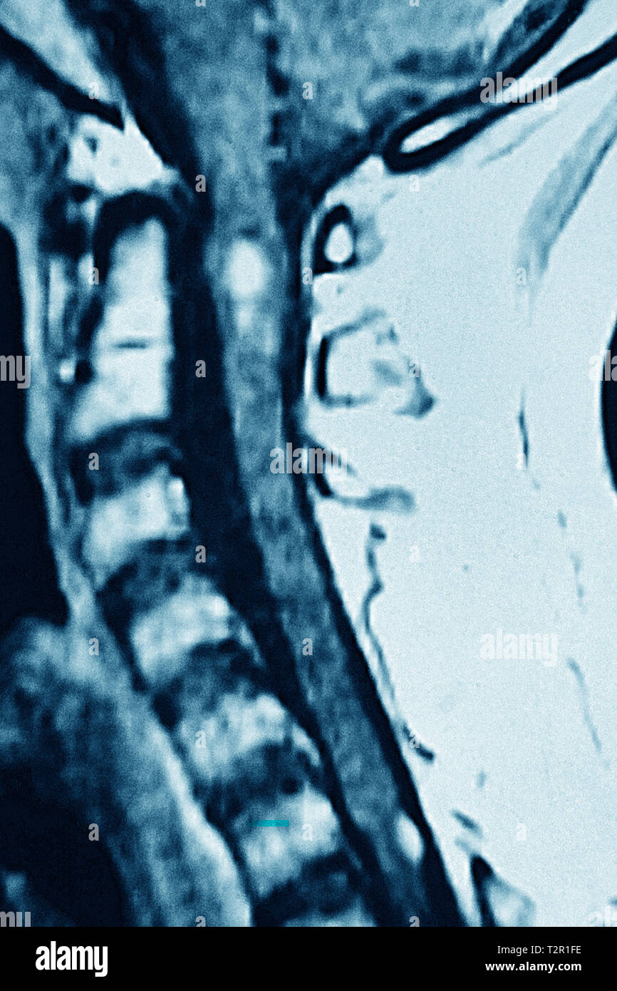 Neurinoma spinale immagini e fotografie stock ad alta risoluzione - Alamy