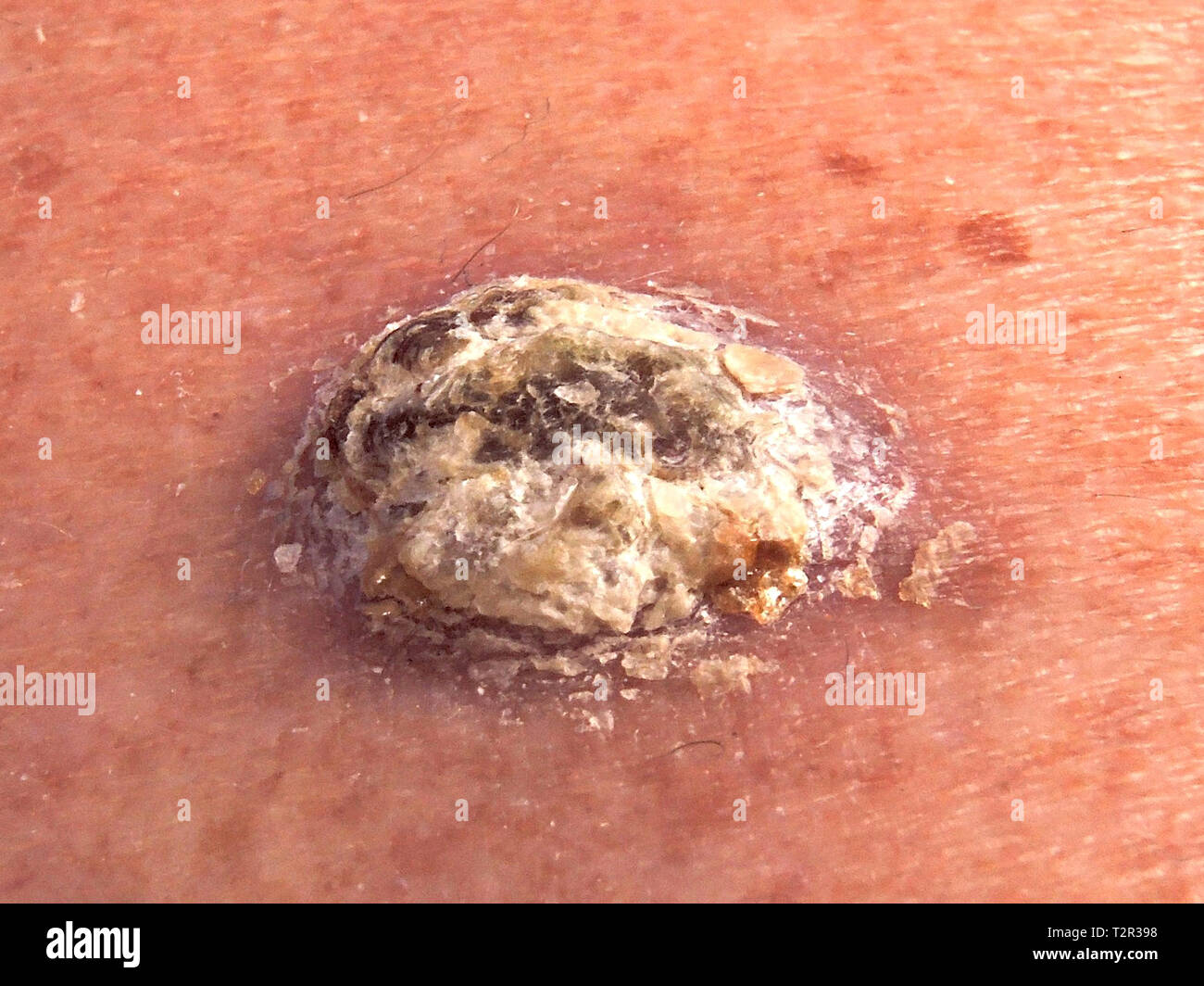 Cancro delle cellule basali immagini e fotografie stock ad alta ...