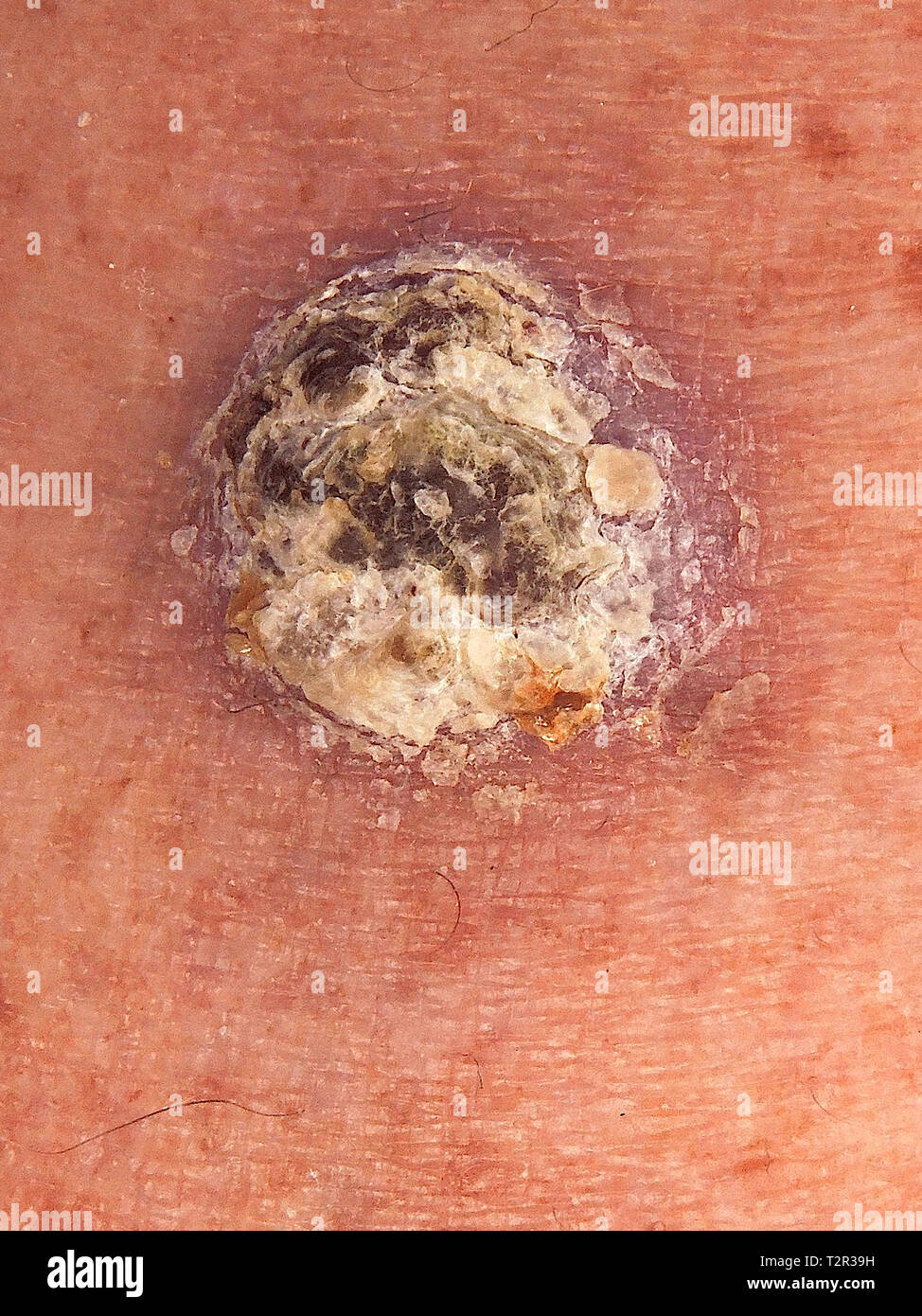 Cancro delle cellule basali immagini e fotografie stock ad alta ...