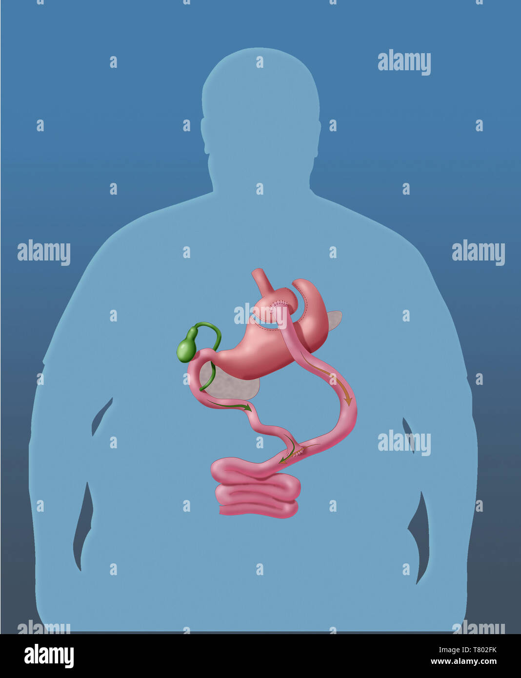 Intervento di bypass gastrico immagini e fotografie stock ad alta ...
