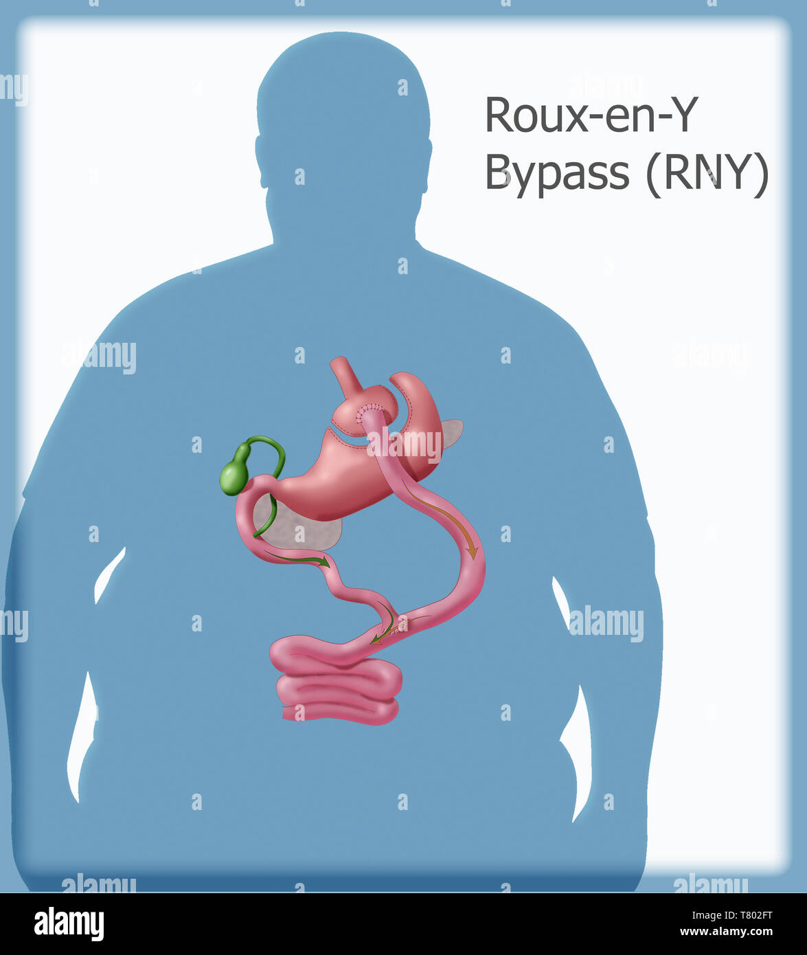 Intervento di bypass gastrico immagini e fotografie stock ad alta ...
