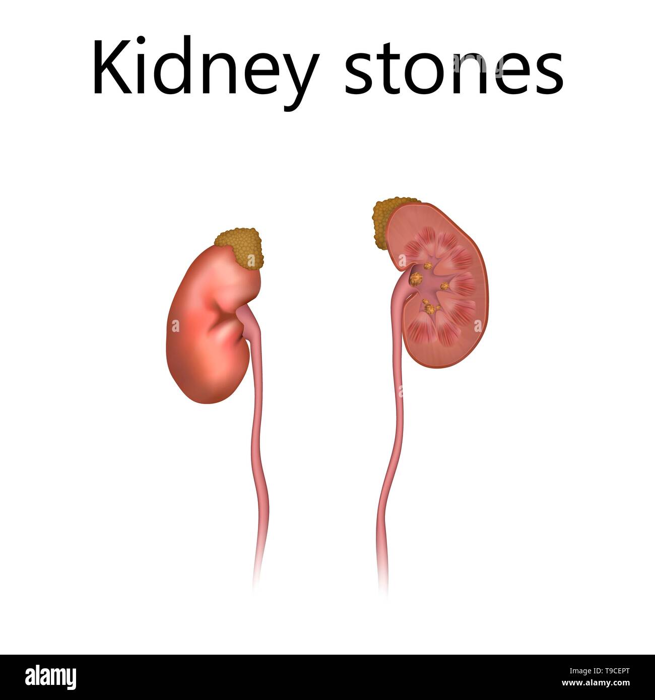 Calcolo renale umano Immagini senza sfondo e Foto Stock ritagliate - Alamy