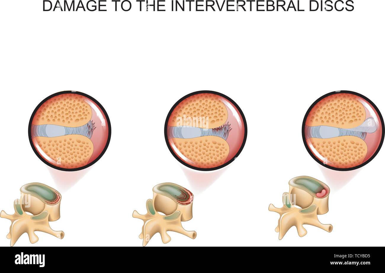 Illustrazione vettoriale del disco intervertebrale danni. La vertebra ...