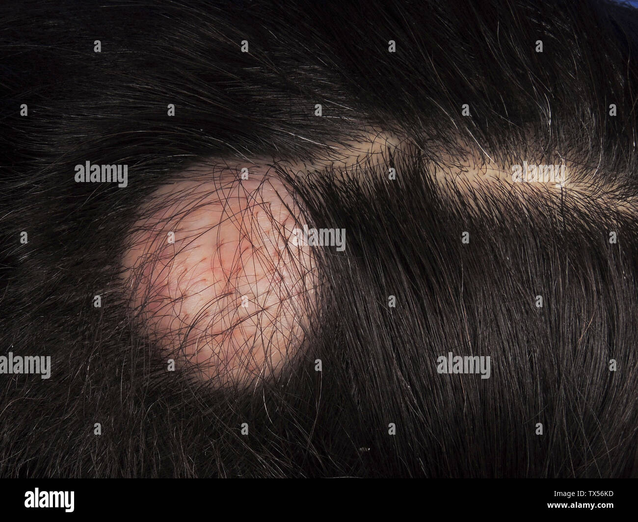 Cisti trichilemmale immagini e fotografie stock ad alta risoluzione - Alamy