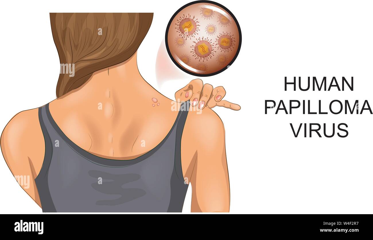 Cosa e' il papilloma della pelle immagini e fotografie stock ad alta ...