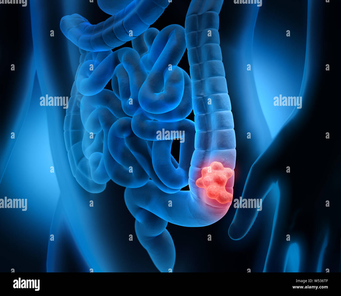 Polipo del colon immagini e fotografie stock ad alta risoluzione - Alamy