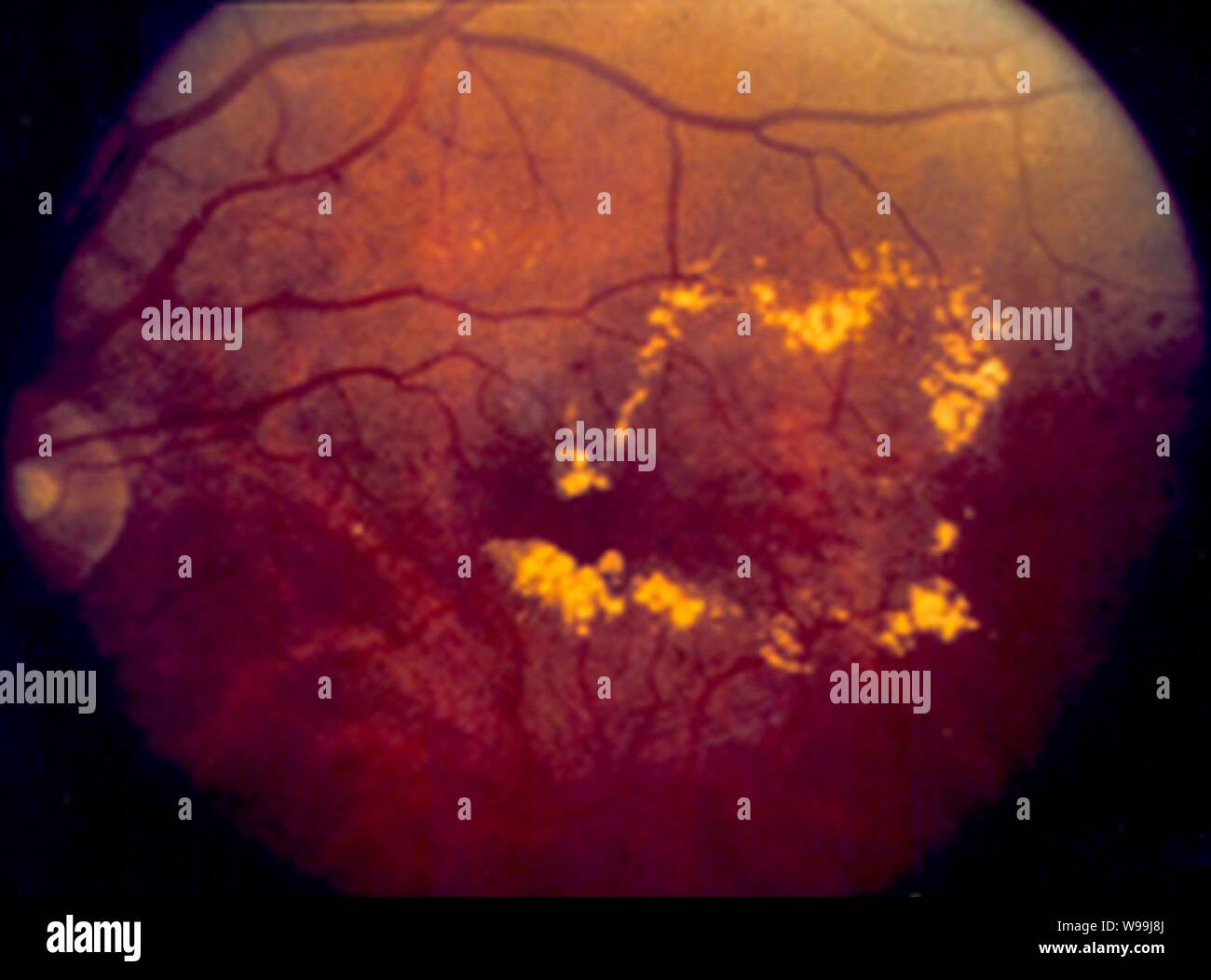 Edema maculare diabetico immagini e fotografie stock ad alta ...