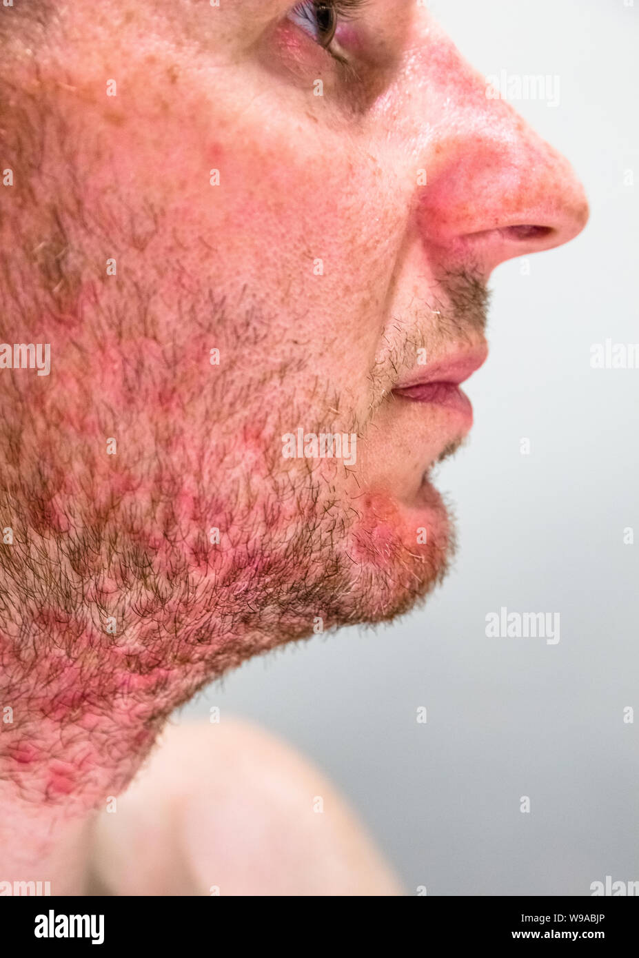 Dettaglio dell'uomo mento con dermatite seborroica nell'area della ...