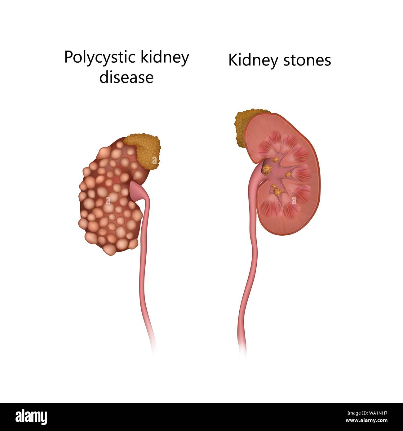 Il rene policistico immagini e fotografie stock ad alta risoluzione - Alamy