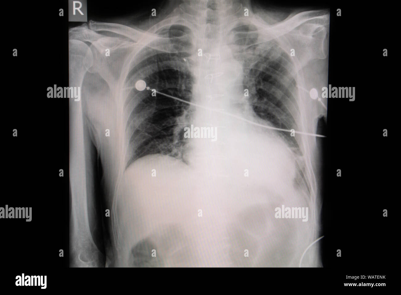 Radiografia del torace normale immagini e fotografie stock ad alta ...