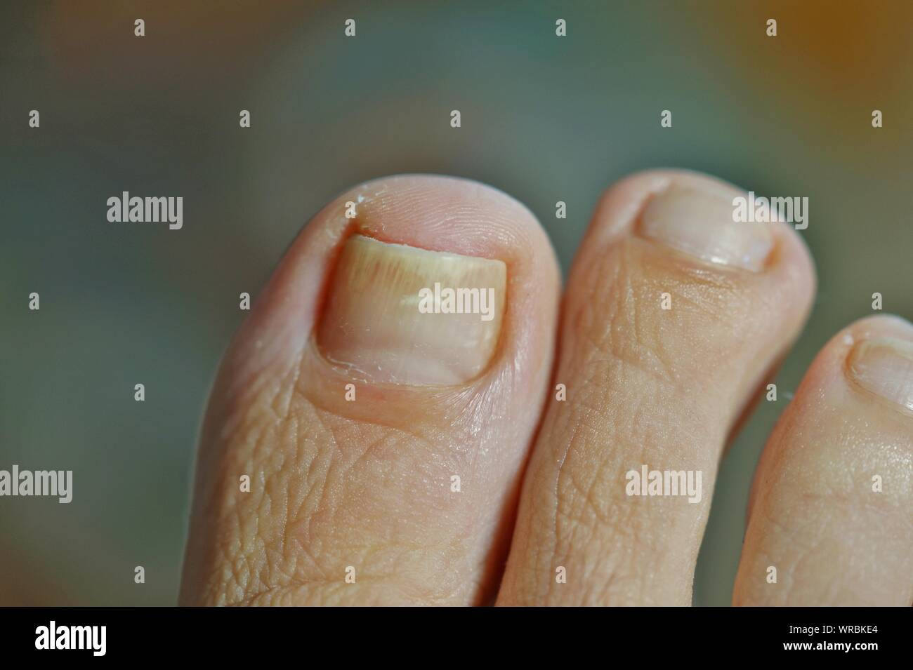 Psoriasis nails immagini e fotografie stock ad alta risoluzione - Alamy