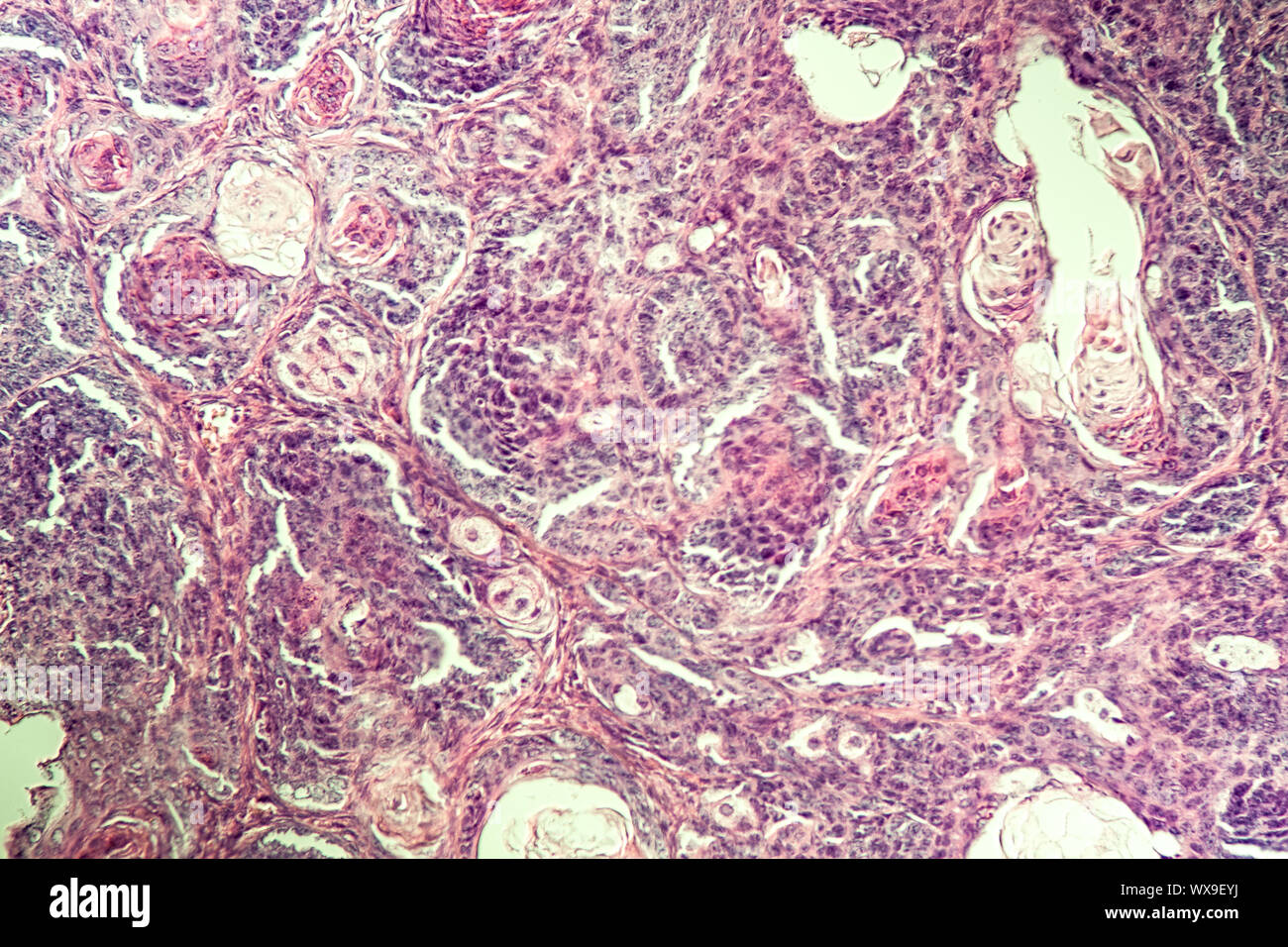 Carcinoma spinale immagini e fotografie stock ad alta risoluzione - Alamy