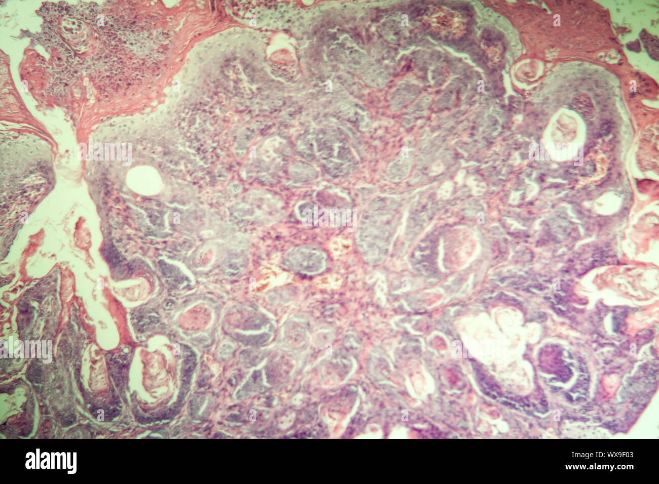 Carcinoma spinale immagini e fotografie stock ad alta risoluzione - Alamy