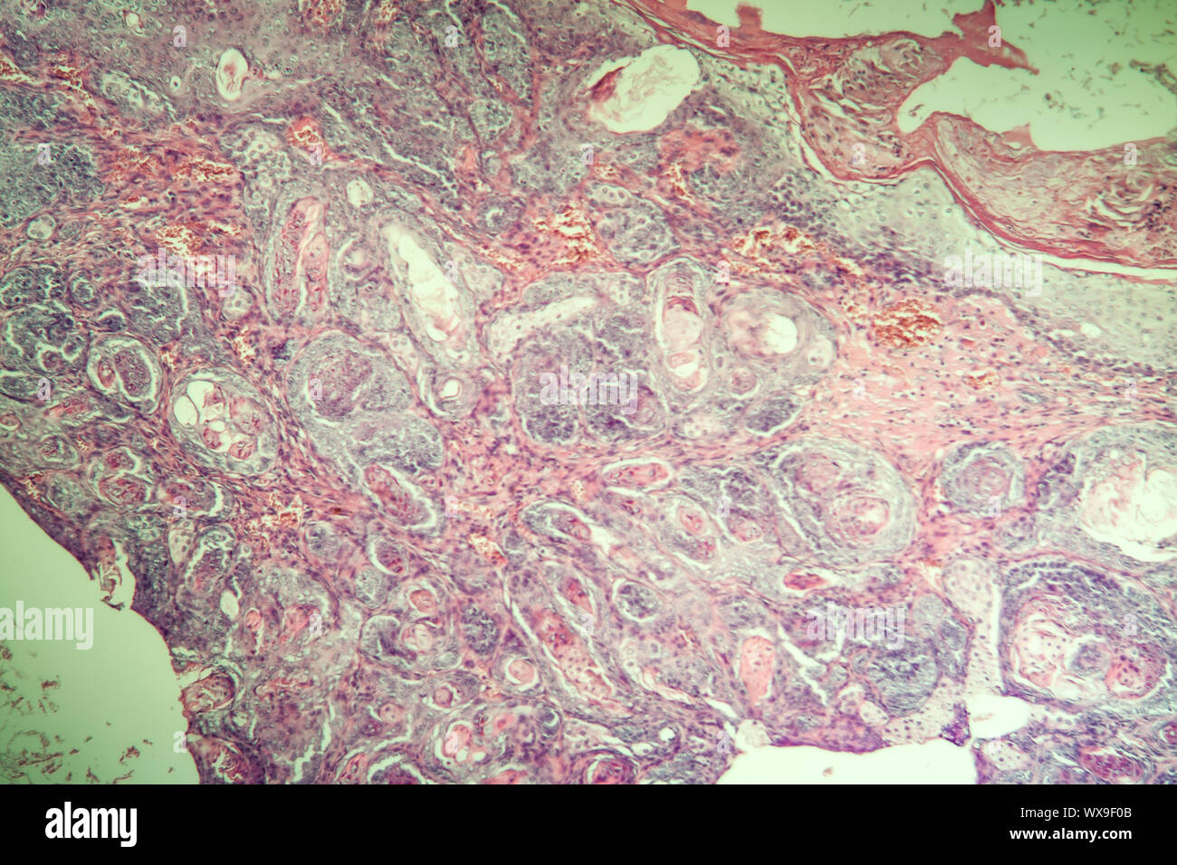 Carcinoma spinale immagini e fotografie stock ad alta risoluzione - Alamy